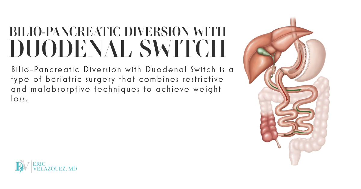What You Need to Know about Bilio-Pancreatic Diversion with Duodenal Switch