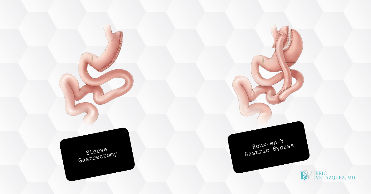 Sleeve Gastrectomy And Roux-en-Y Gastric Bypass: What you Need to Know ...