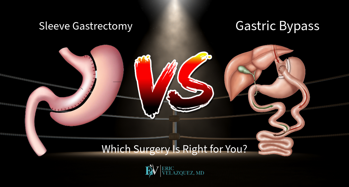 Sleeve Gastrectomy vs. Gastric Bypass: Which Bariatric Surgery Is Right ...